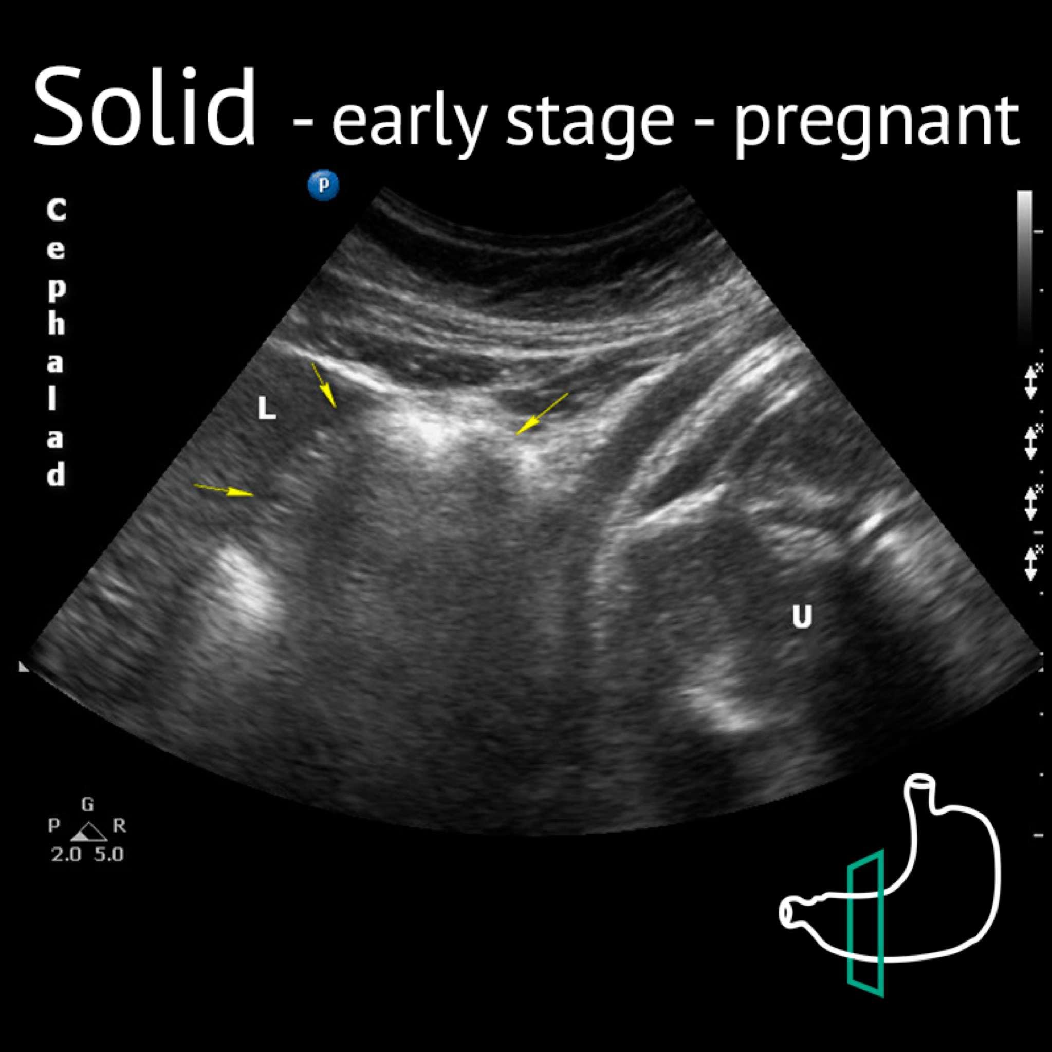 Gastric UltraSound • Image Gallery
