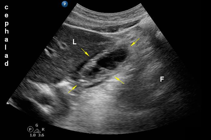 Gastric UltraSound • Pregnant
